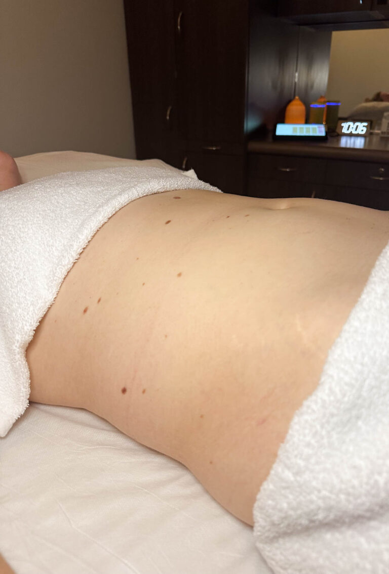 Brazilian Lymphatic Drainage Massage - Before & After Photos